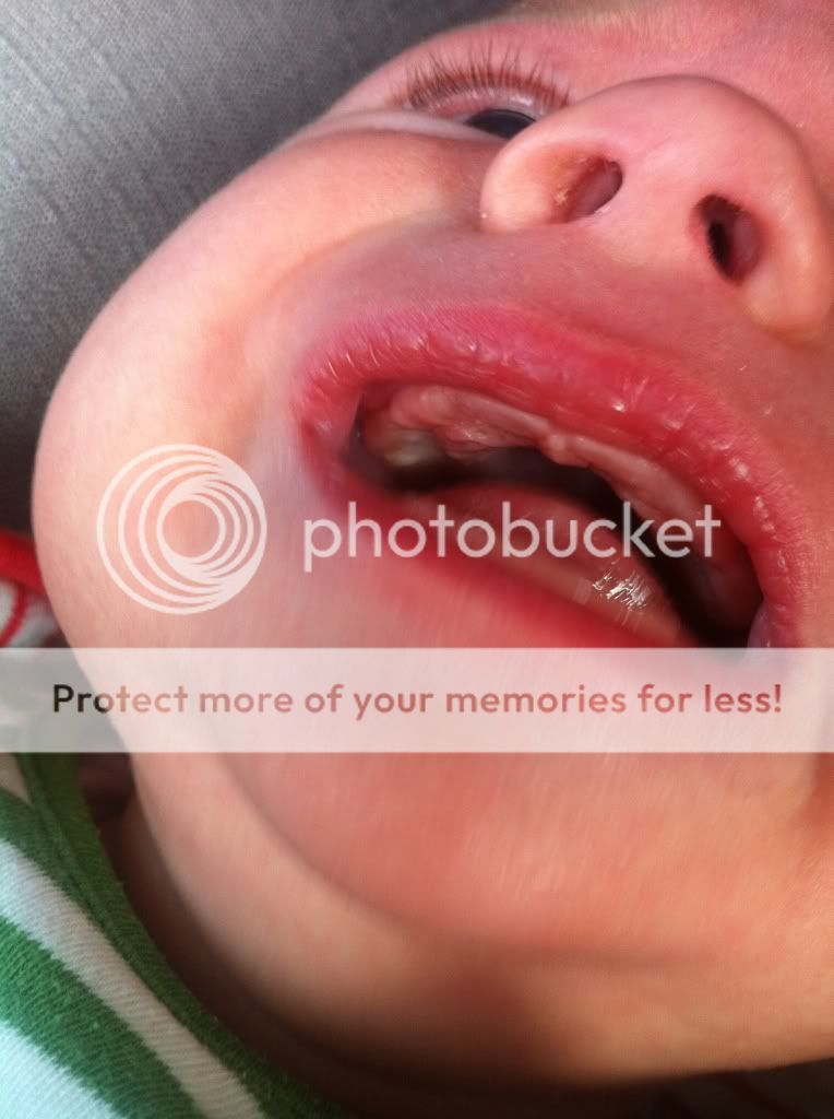 Bohn's nodules | BabyCentre